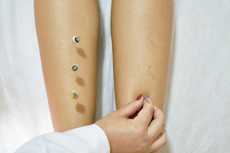 How Acupuncture May Support a Calmer Nervous System in Scottsdale
