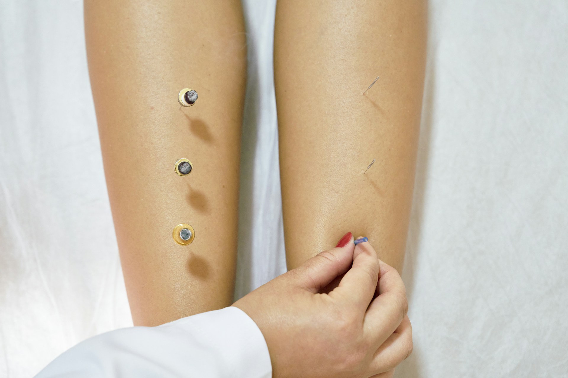 How Acupuncture May Support a Calmer Nervous System in Scottsdale